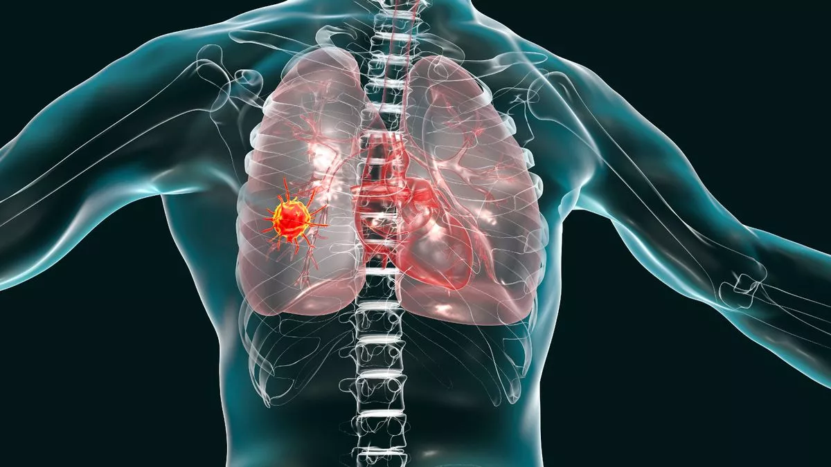 Type of white blood cell indicates likelihood of cancer spread - Dr ...